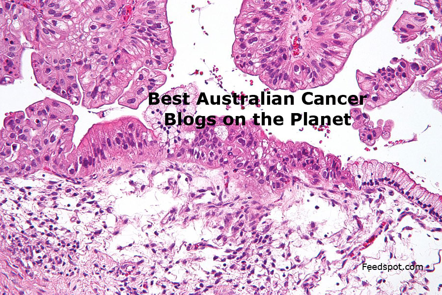 10 Best Australian Cancer Blogs and Websites in 2025